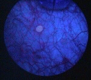 Cysview
